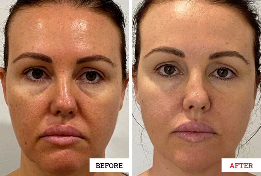 PDO Mono Threads – Skinstitute