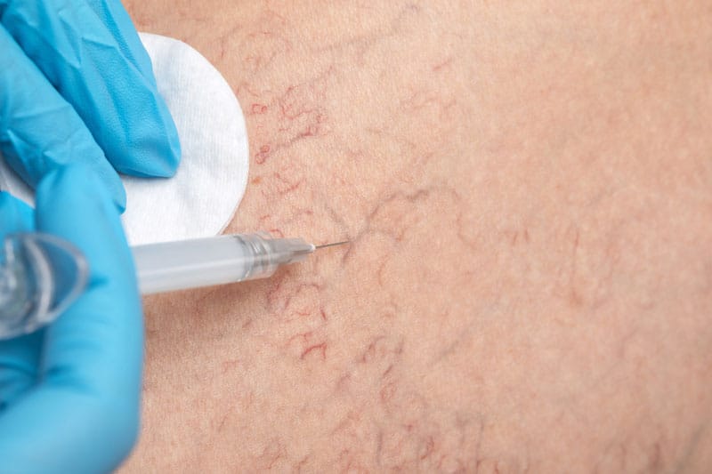 Sclerotherapy – Skinstitute